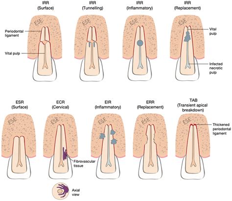 External Resorption Vs Internal Resorption