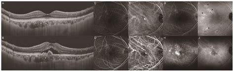 Clinical Characteristics Of Punctate Hyperfluorescence Spots In The