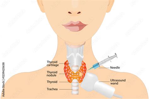 Fine Needle Aspiration Biopsy Of The Thyroid Gland In A Patient Using An Ultrasound Machine