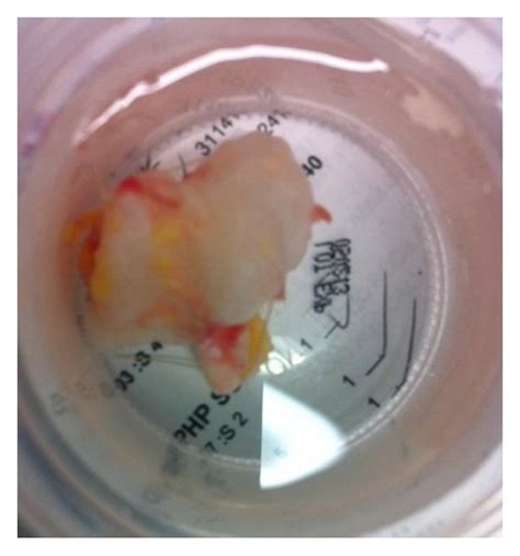 Gross Pathological Specimen Of Resected Tumor Showing Dumbbell Download Scientific Diagram