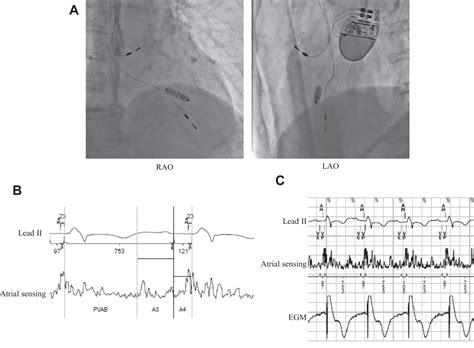 Atrioventricular Synchronous Pacing Using A Transvenous Right Atrial Lead And An Atrial