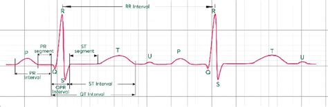 Figure 1 From Ecg Arrhythmia Classification Using Ensemble Of Features