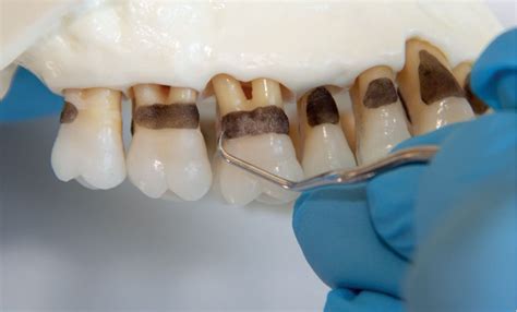 Effective Instrumentation With Lm™ Langer Curettes Lm Dental