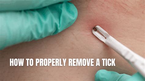 Tick Removal Kits And Safety For Canadian Outdoor Workers What You Need
