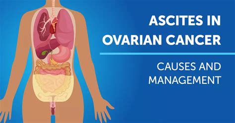 Managing Your Condition Myovariancancerteam