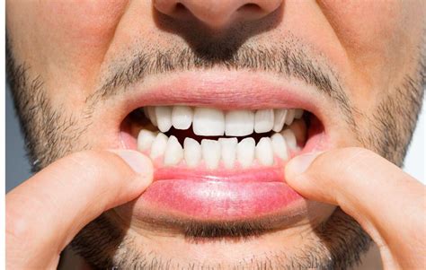 Worst Teeth In The World Which Country Has Them