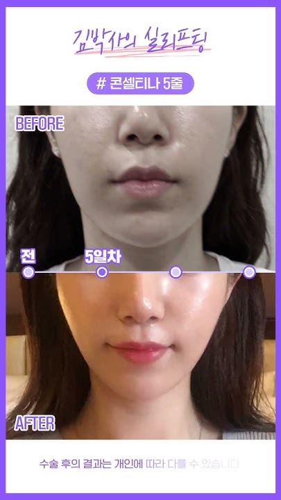 Shorts 강남12 실리프팅 콘셀티나 5줄 살처짐 이중턱 투턱 팔자주름 개선 리프팅효과 Youtube