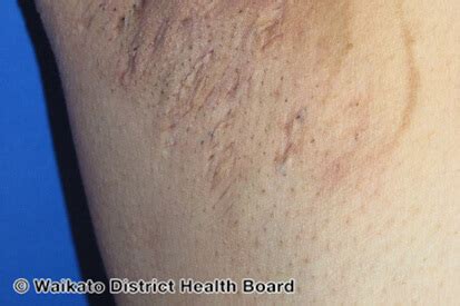 Hidradentis Suppurativa Symptoms And Treatment Dermatology Of