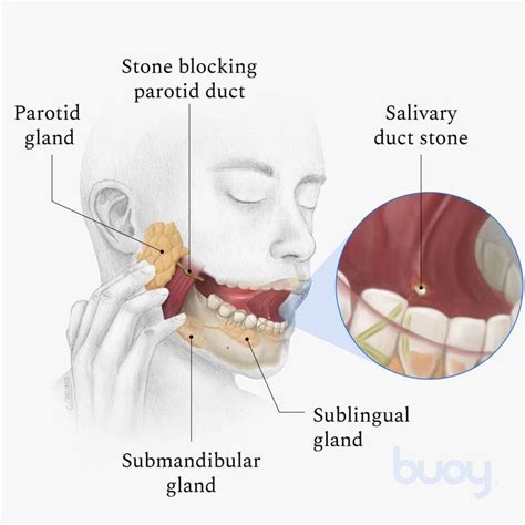 Submandibular Duct