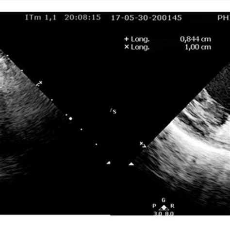 1 2d Echocardiography Showing The Mobile Thrombus Arrow Inside The Download Scientific