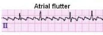 Atrial Flutter Flashcards Quizlet