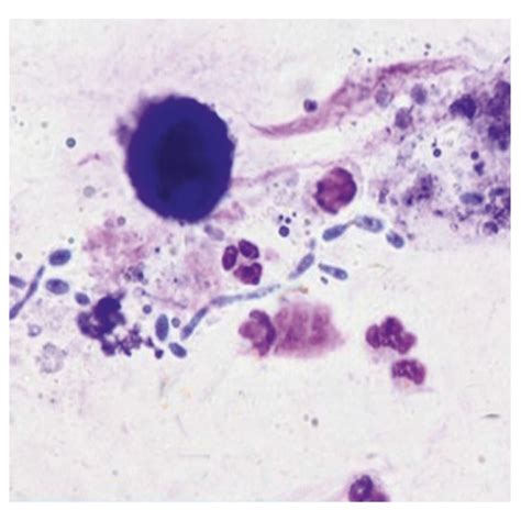 Demonstration Of Yeast In A Direct Smear Made From Sputum Note The