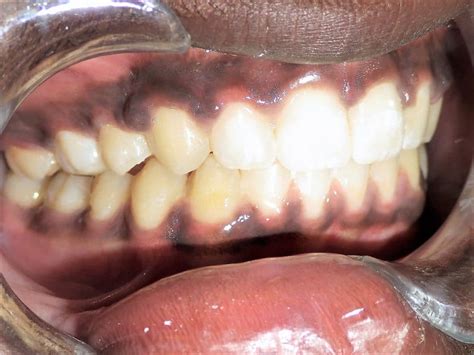 Braces Before And After Overbite Causes Symptoms Treatments