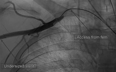 Angiography Via Right Femoral Access Showing Distal Migration Of