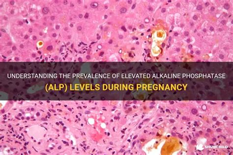 Understanding The Prevalence Of Elevated Alkaline Phosphatase Alp