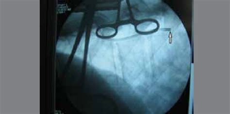 Thecaloscopy Of The Ventral Subarachnoid Space The Distal End Of The Download Scientific