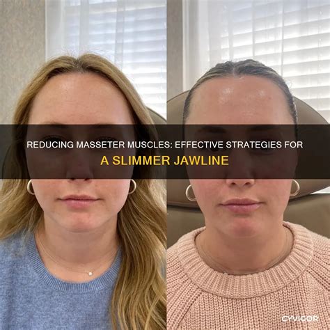 Reducing Masseter Muscles Effective Strategies For A Slimmer Jawline