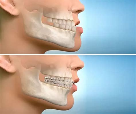 Can Braces Make Your Jaw Lock At Stuart Witt Blog