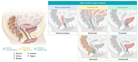 Rectocele Stages