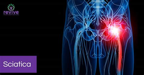 Sciatica Revive Physio Therapy And Pilates