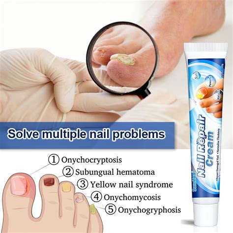 Toenail Fungus Treatment Cream Nail Fungus Stop Fungi Nail Fungus