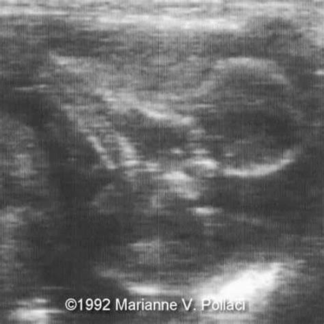 📃 Twins Conjoined Duplicata Incompleta Dicephalus