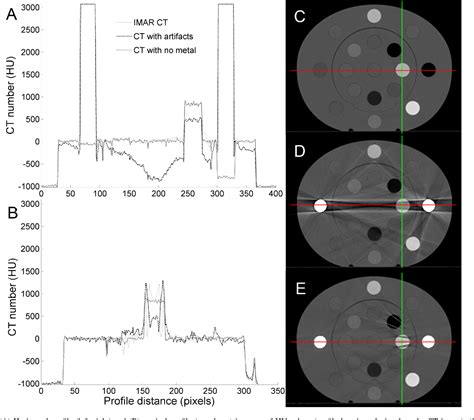 Figure 8 From Clinical Evaluation Of The Iterative Metal Artifact Reduction Algorithm For Ct