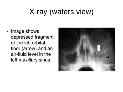 Ppt Orbital Blowout Fractures Powerpoint Presentation Free Download