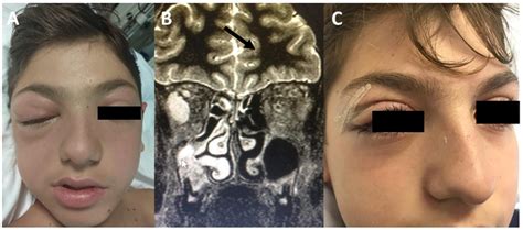 A A 13 Year Old Patient With Acute Maxillary Sinusitis An Orbital