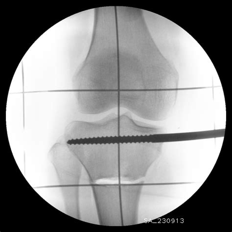 Lowerknee Instance Segmentation Dataset By Drjo