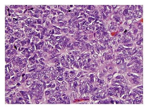 Peripheral Primitive Neuroectodermal Tumor With Homer Wright Rosettes