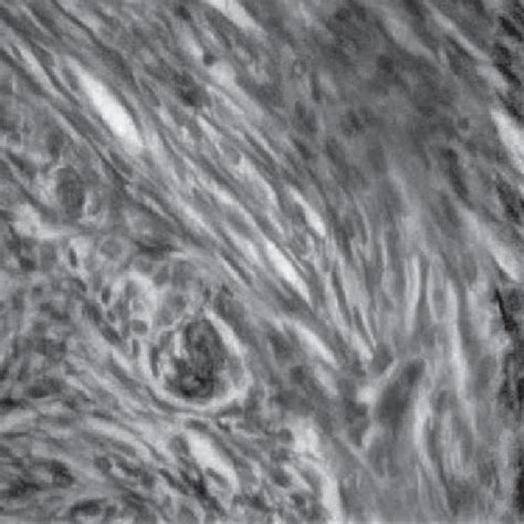 Microscopic Appearance Of Left Ovarian Thecoma Hematoxylin Eosin 400