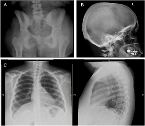 X Rays Showing Diffuse Bone Sclerosis A Pelvis B Left Lateral View Of Download Scientific