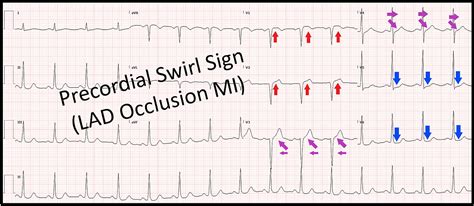Precordial Swirl Sign A New Ecg Pattern Of Left Anterior Descending Artery Occlusion Myocardial