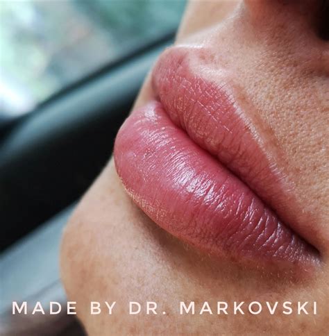 Д р Тодор Йорданов Пореден пример че появата и нарастването на новообразувания по кожата не