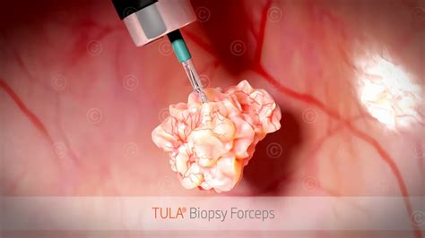 Animation Bladder Cancer Treatment Medicalgraphics