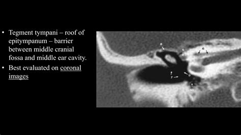 Ct Temporal Bone Pptx