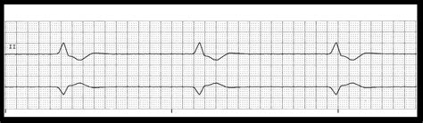 Ventricular Rhythm Quiz 294