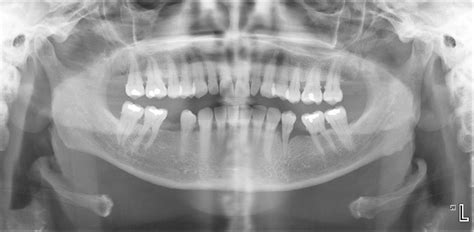 Subgingival Calculus