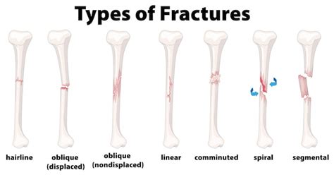 Premium Vector A Set Of Bone Fractures Premium Vector A Set Of Bone Fractures
