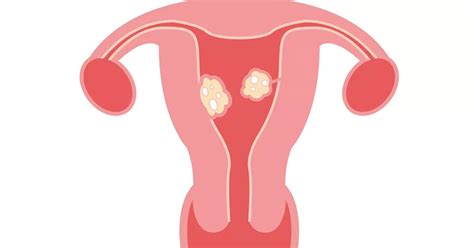 Fibroids Size What Do I Need To Know