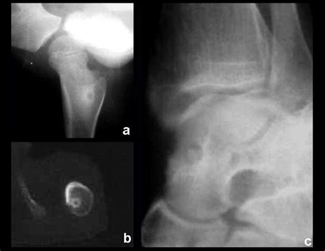 Osteoid Osteoma Oncosurgery