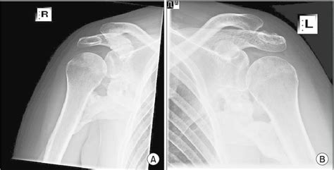 Preoperative Roentgenogram Of The Right Shoulder Joint A And The Left