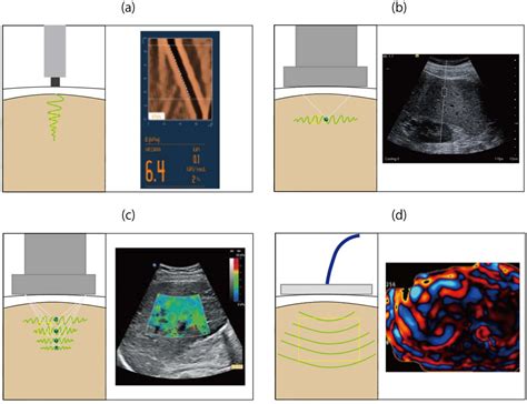 What Is Vibration Controlled Transient Elastography At Jerry Rounds Blog