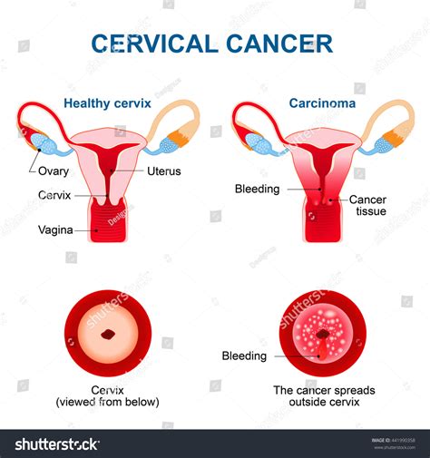 Cervical Cancer Malignant Neoplasm Arising From Cells In The Cervix Uteri Vaginal Bleeding
