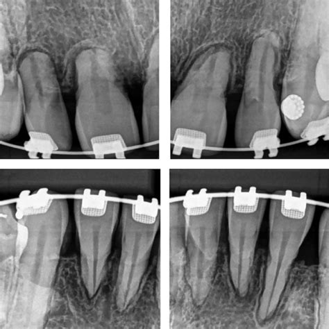 Active Extreme External Inflammatory Apical Resorption In Maxillary