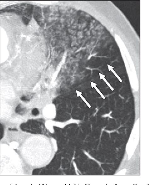 Figure From Tree In Bud Pattern Semantic Scholar