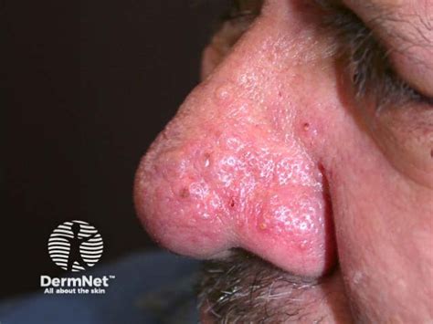 Follicular Disorders Rosacea