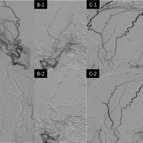 Endovascular Onyx Embolization Of Dural Arteriovenous Fistulas A Download Scientific Diagram