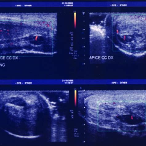 Penile Us Showing A Solid Hypoechoic Vascularized Lesion That Rises